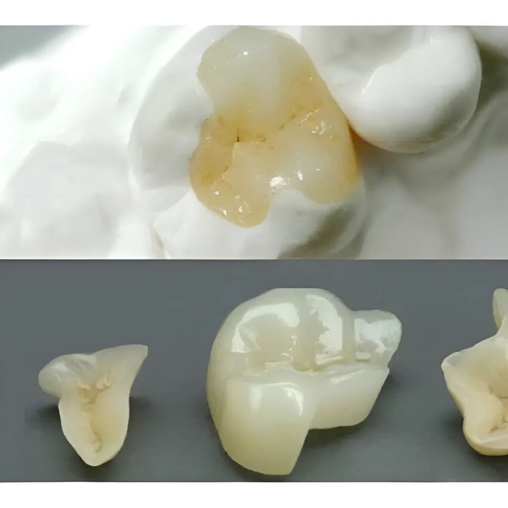 Exocad Crown & Bridge CAD Services | Fast Turnaround