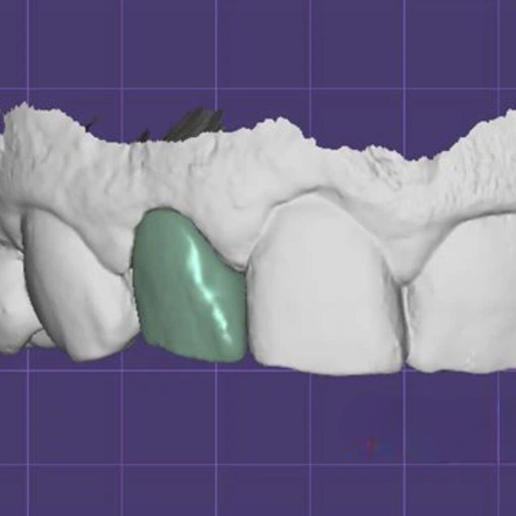 Exocad Crown & Bridge CAD Services | Fast Turnaround